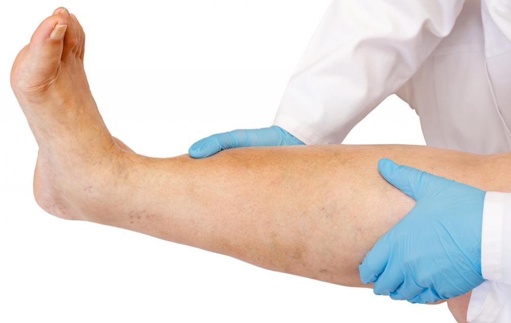 What Is Lower Extremity Edema with Pictures 