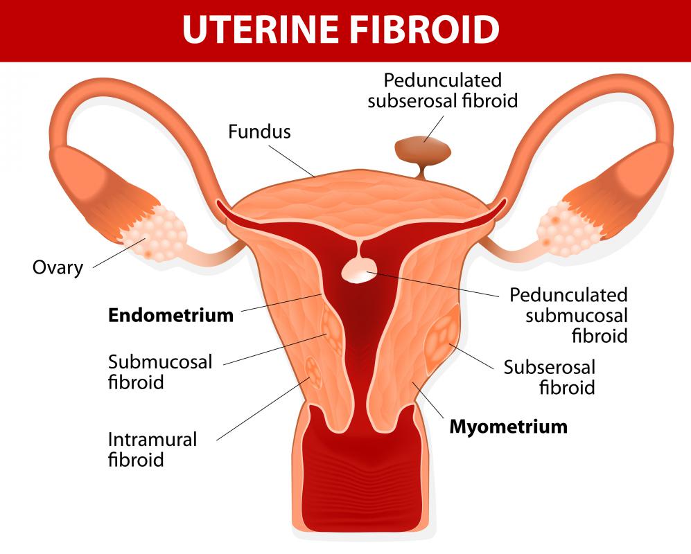 What Is An Adnexal Mass with Pictures What Is An Adnexal Mass with Pictures