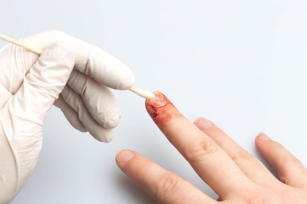 How Do I Treat An Ingrown Fingernail with Pictures How Do I Treat An Ingrown Fingernail with Pictures