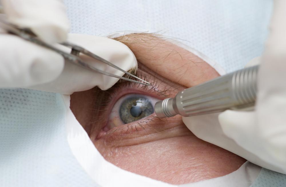 What Is Rotatory Nystagmus with Pictures What Is Rotatory Nystagmus with Pictures